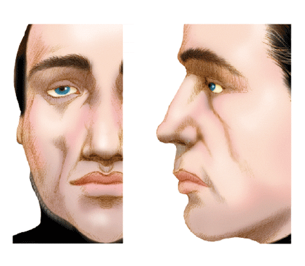 Lipodistrofias y diabetes: El ninja porculero asociado a la dulce.